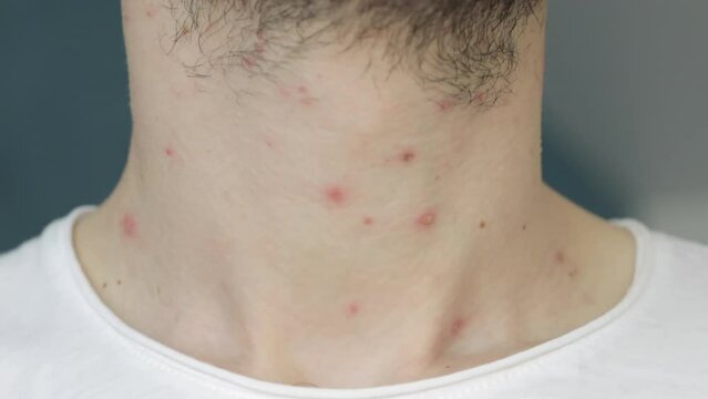 Zoster Images – Browse 65,803 Stock Photos, Vectors, and Video | Adobe ...