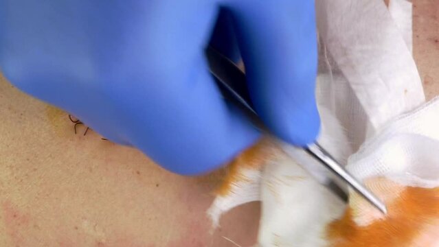 Suture Video Footage – Browse 2,640 HD Stock Video and Footage | Adobe ...