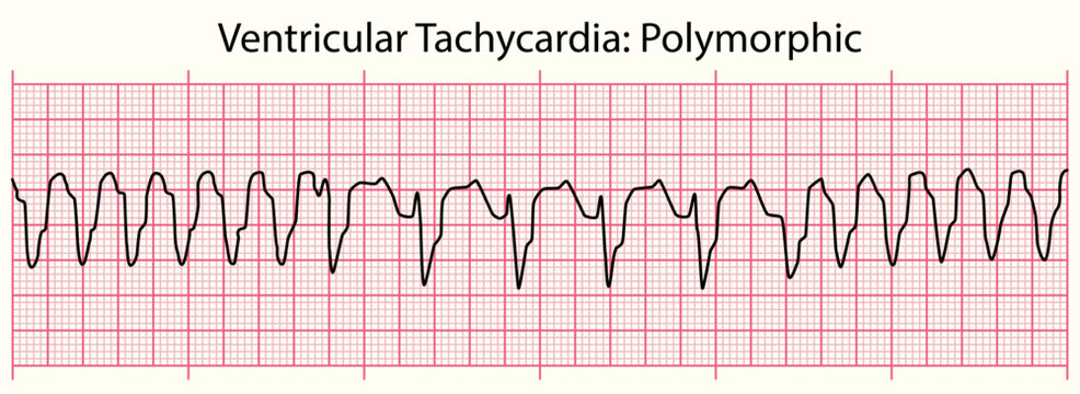 Polymorphic Ventricular Tachycardia Strip