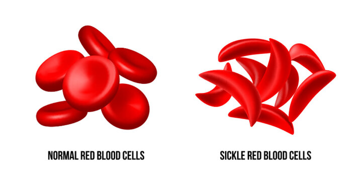 "Sickle Cell Anemia" Images – Browse 20,479 Stock Photos, Vectors, and ...