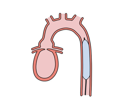 Intra Aortic Balloon Pump Animation