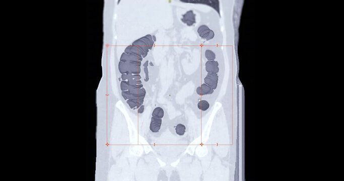 "Sigmoid Flexure" Images – Parcourir 582 le catalogue de photos ...