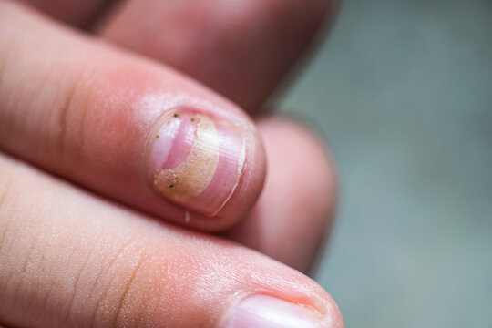 Imágenes de Herpangina: descubre bancos de fotos, ilustraciones ...