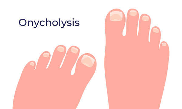 Onychomadesis Bilder – Durchsuchen 154 Archivfotos, Vektorgrafiken und ...