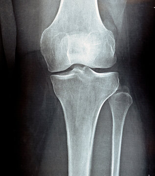 Osteophyte Images – Browse 991 Stock Photos, Vectors, and Video | Adobe ...