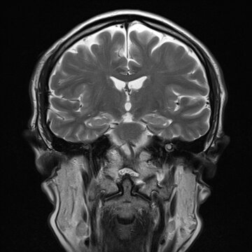 「Coronal Section Brain」の写真素材 | 152件の無料イラスト画像 | Adobe Stock