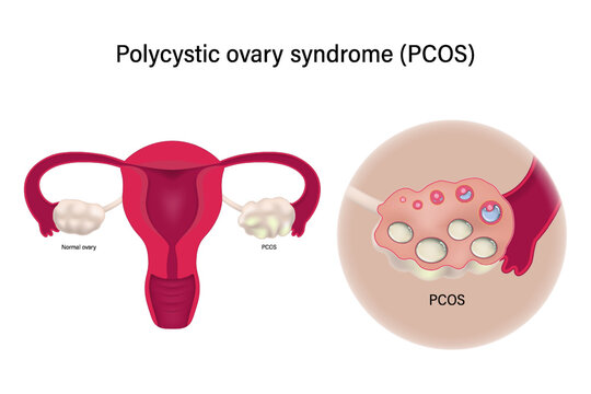 "Polycystic Ovary" Bilder – Durchsuchen 1,894 Archivfotos ...
