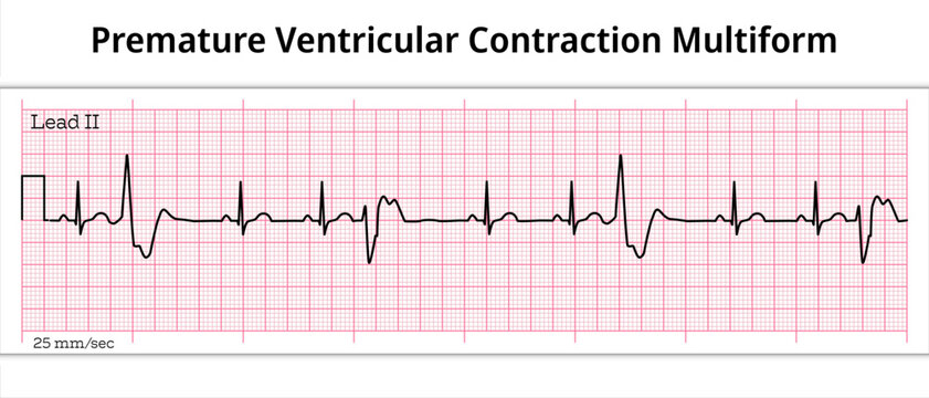 Multifocal Premature Ventricular Contractions