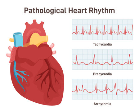 What Does A Heart Attack Look Like On An EKG? CardiacDirect