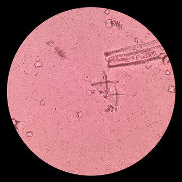 Calcium Phosphate Crystals In Urine