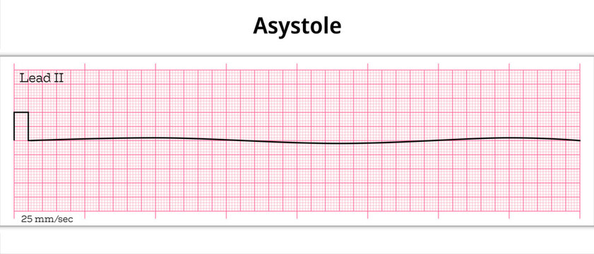 Asystole bilder – Bläddra bland 6,226 stockfoton, vektorer och videor ...