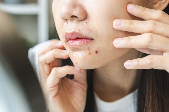 Pustules Imagens – Procure 464,195 fotos, vetores e vídeos | Adobe Stock