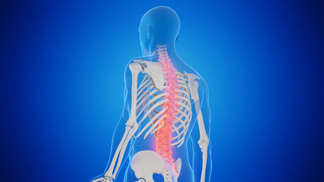 Spondylarthrose Bilder – Durchsuchen 376 Archivfotos, Vektorgrafiken ...