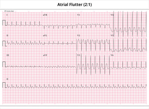 Atrial Fibrillation Ecg Images – Browse 613 Stock Photos, Vectors, and ...