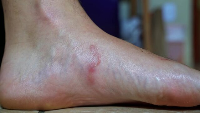 Hookworm Images – Browse 777 Stock Photos, Vectors, and Video | Adobe Stock