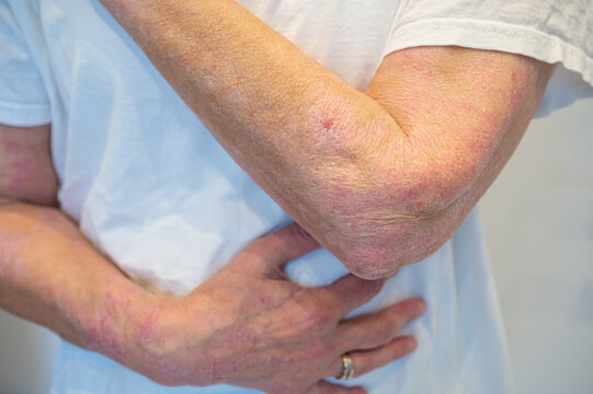 รูปภาพNeurodermatitis – เลือกดูภาพถ่ายสต็อก เวกเตอร์ และวิดีโอ496 ...