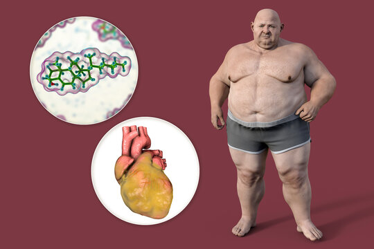 รูปภาพDyslipidemia – เลือกดูภาพถ่ายสต็อก เวกเตอร์ และวิดีโอ802 | Adobe ...