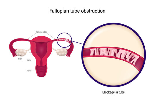 Fallopian Tube Diagram