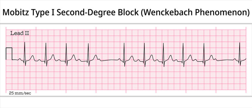 「Wenckebach」の写真素材 | 14件の無料イラスト画像 | Adobe Stock