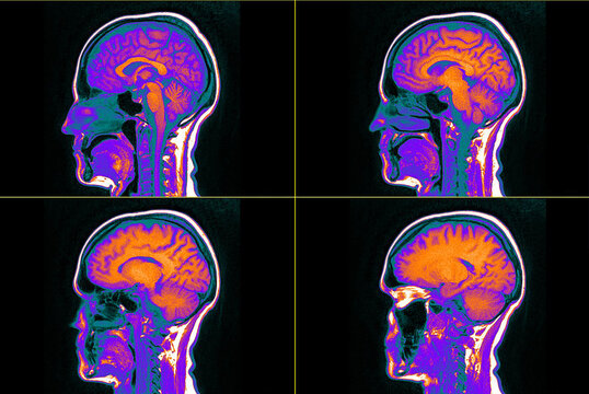 Intracerebral Bilder – Durchsuchen 349 Archivfotos, Vektorgrafiken und ...