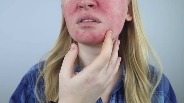 Couperosis - Images et vidéos libres de droits | Adobe Stock