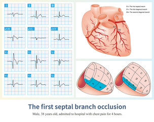 Naklejka The proximal occlusion of the left anterior descending artery ...