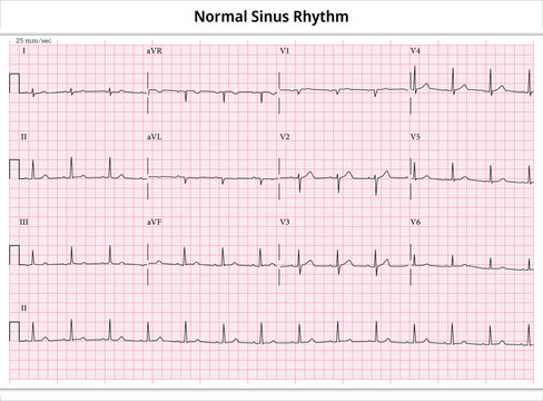 Normal 12 Lead Ecg