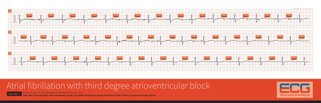 "Heart Block" bilder – Bläddra bland 303 stockfoton, vektorer och ...