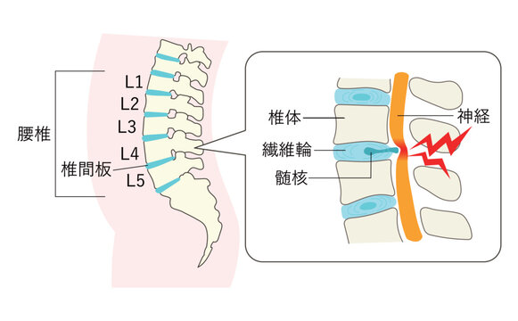 ヘルニア Images – Browse 2,081 Stock Photos, Vectors, and Video | Adobe Stock