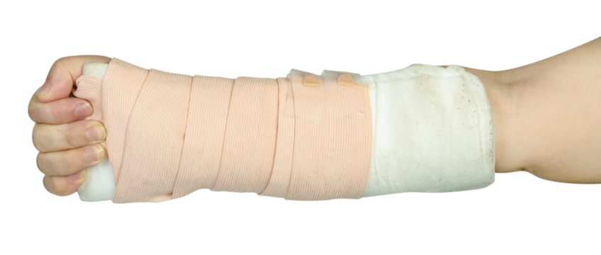 Sprain At Thumb Sprains PNGs – Transparent Background Images | PikWizard