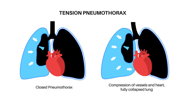 รูปภาพPneumothorax – เลือกดูภาพถ่ายสต็อก เวกเตอร์ และวิดีโอ8,765 ...