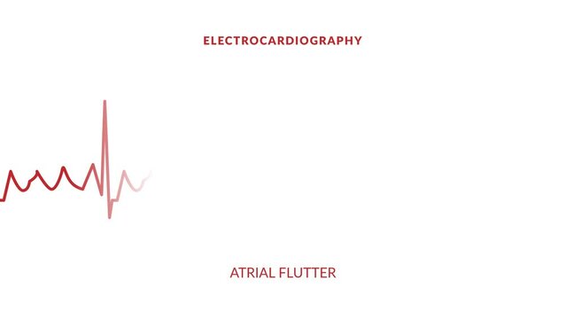 "Atrial Flutter" Images – Browse 723 Stock Photos, Vectors, and Video ...