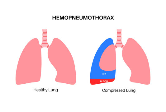 Hemopneumothorax