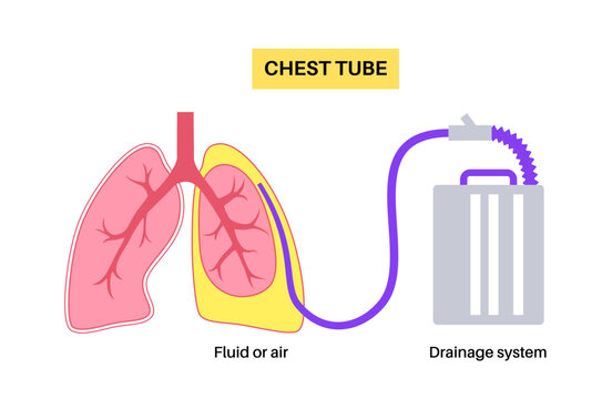 รูปภาพThoracostomy – เลือกดูภาพถ่ายสต็อก เวกเตอร์ และวิดีโอ88 | Adobe Stock