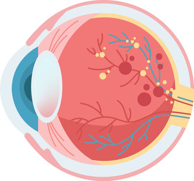 "Eye Damage" Images – Browse 828 Stock Photos, Vectors, and Video ...