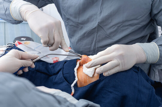 Skin Flap Images – Browse 1,005 Stock Photos, Vectors, and Video ...