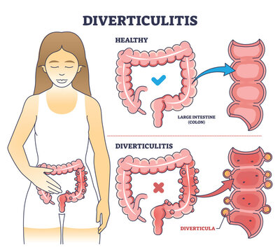 Imágenes de Diverticulitis: descubre bancos de fotos, ilustraciones ...