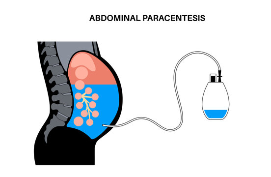 รูปภาพParacentesis – เลือกดูภาพถ่ายสต็อก เวกเตอร์ และวิดีโอ288 | Adobe ...