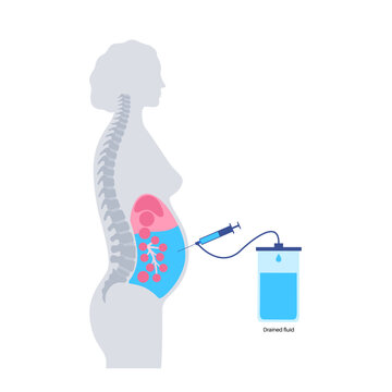 Paracentesis Images – Browse 264 Stock Photos, Vectors, and Video ...