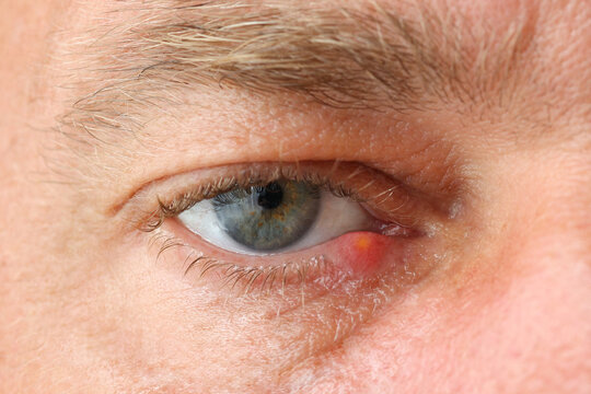 Blefarit bilder – Bläddra bland 1,125 stockfoton, vektorer och videor ...