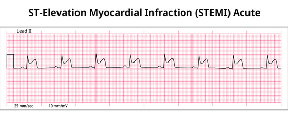 Plakat Set of ECG Common Abnormalities - Bigeminy vs Trigeminy ...