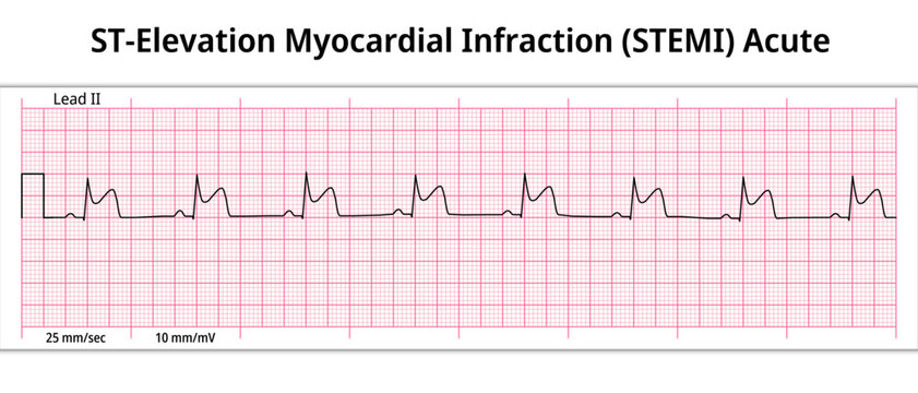Myocardial Infarction Ecg