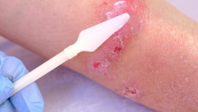 Scalded Imagens – Procure 7,262 fotos, vetores e vídeos | Adobe Stock