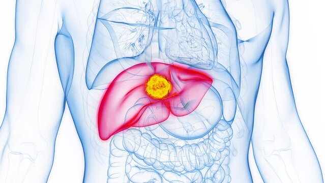 "Liver Cancer" Images – Browse 4,117 Stock Photos, Vectors, and Video ...