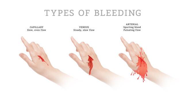 "Arterial Bleeding" Images – Browse 159,287 Stock Photos, Vectors, and ...