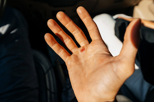 Worker Hand Injury Images – Browse 10,537 Stock Photos, Vectors, and ...