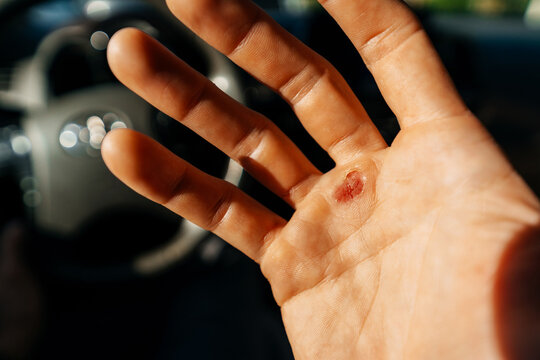 Worker Hand Injury Images – Browse 10,537 Stock Photos, Vectors, and ...