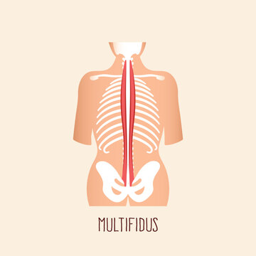 Multifidus Triangle Syndrome