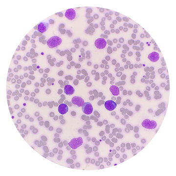 Basket Cell Blood Smear