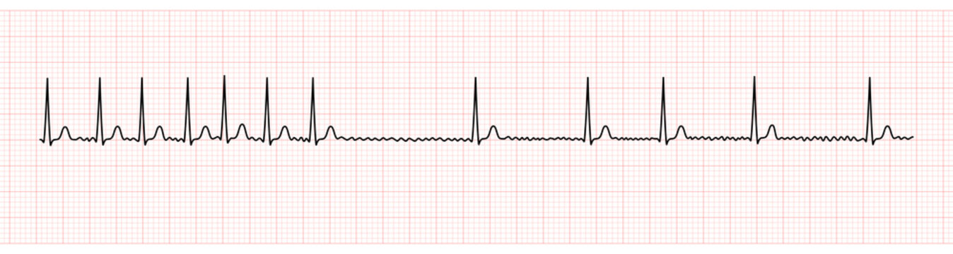 Ventricular Fibrillation Rhythm Strip